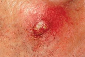 Staphylococcus aureus infection with PVL toxin | GPonline