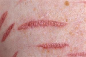 Paediatric medicine - Self-harming in young people | GPonline