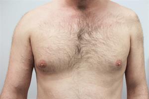 Identifying the cause of a swollen arm | GPonline