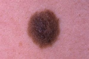 Illustrated - Moles | GPonline