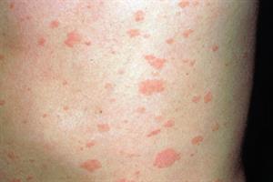 Pictorial case study: Itchy rash with a large lesion | GPonline