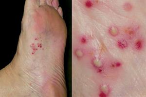 Differential diagnoses - Skin conditions of the feet | GPonline