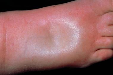 Red flag symptoms and clinical signs | GPonline