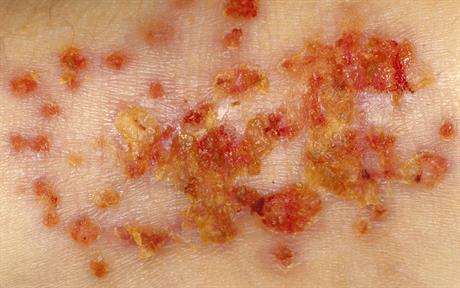 Prescribe antiseptics rather than antibiotics for impetigo, says NICE ...