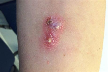 Skin Problems - RCGP Curriculum | GPonline