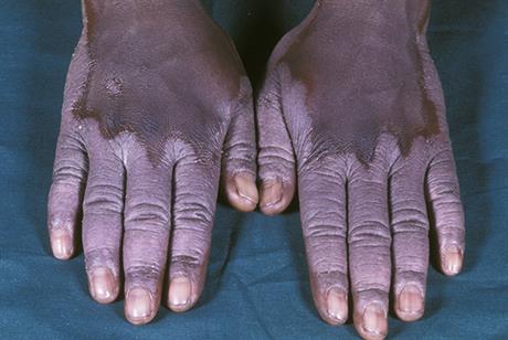 Dermatological conditions in pigmented skin | GPonline