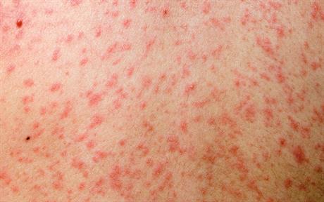 Measles: Clinical review | GPonline