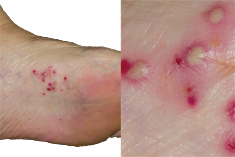 Differential diagnoses: Skin conditions of the feet | GPonline