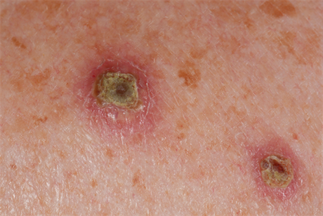 Pancreatic glucagonoma - case study | GPonline