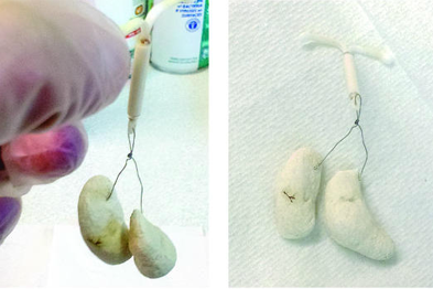 An unusual case of vaginal stones - case study | GPonline