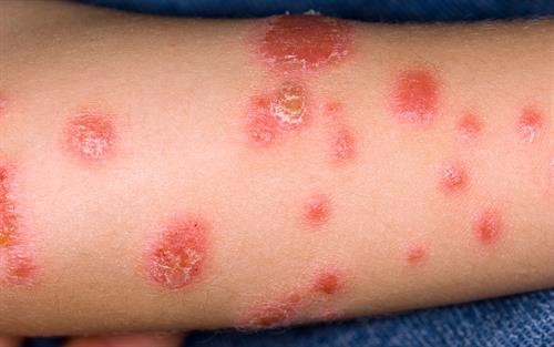 Humira now licensed for psoriasis treatment in children | MIMS online
