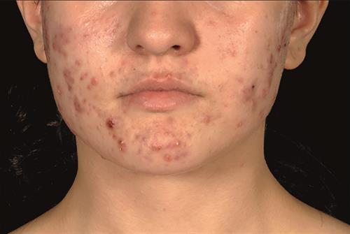 Acne vulgaris: clinical review | GPonline
