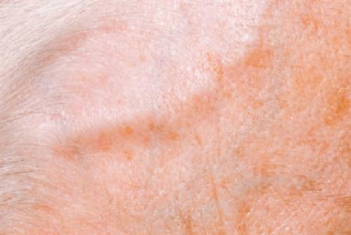 Polymyalgia rheumatica and giant cell arteritis | GPonline