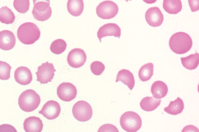 Haematology - Pre-eclampsia and HELLP | GPonline