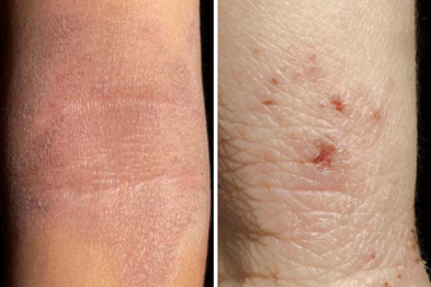 Clinical Review - Atopic eczema | GPonline