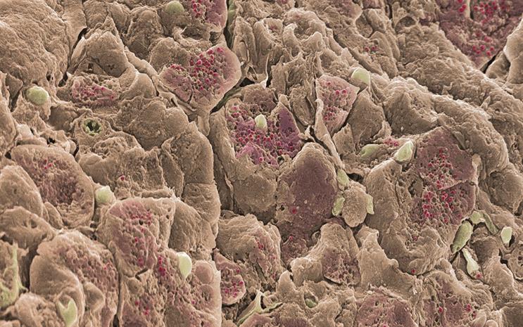 Pancreatic enzyme deficiency | MIMS online