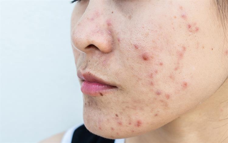 First acne guideline published by NICE | MIMS online