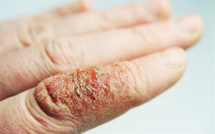 Antibiotic guidance issued for infected eczema | MIMS online