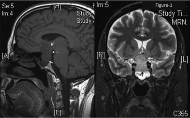 Clinical Review: Hypopituitarism | GPonline