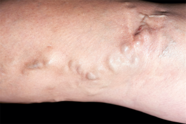Clinical review of varicose veins: epidemiology, diagnosis and ...