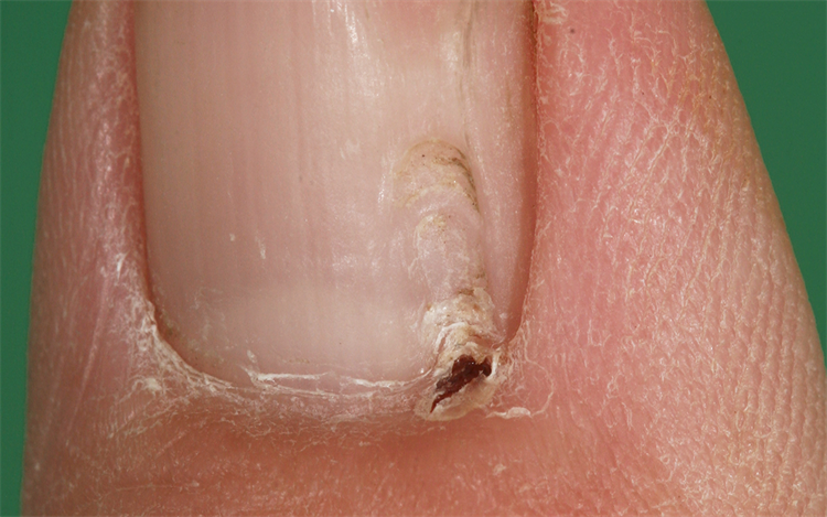 Nail changes - clinical review | GPonline