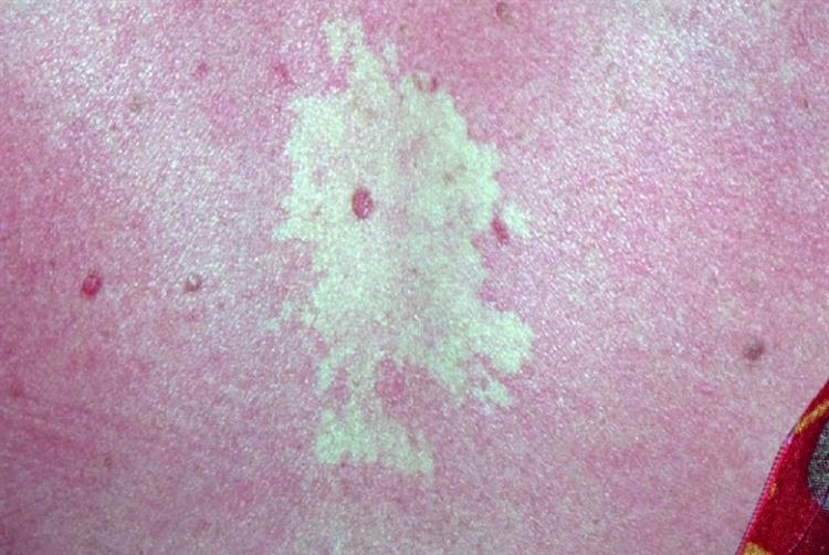 Differential diagnoses: Skin pigmentation | GPonline