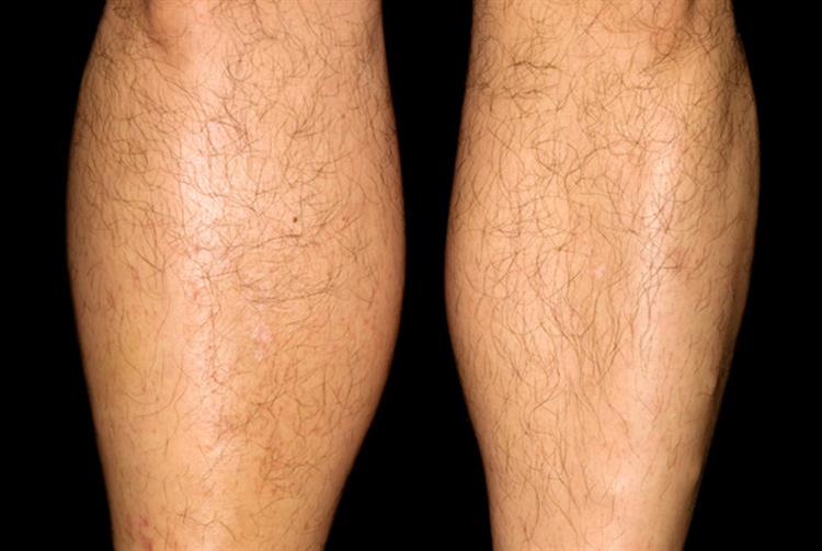Swollen calf - red flag symptoms | GPonline