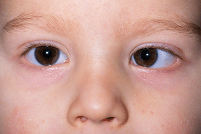 The basics - Strabismus | GPonline