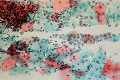 Is a smear test required after hysterectomy? | GPonline