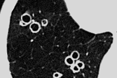 Clinical Review - Bronchiectasis | GPonline