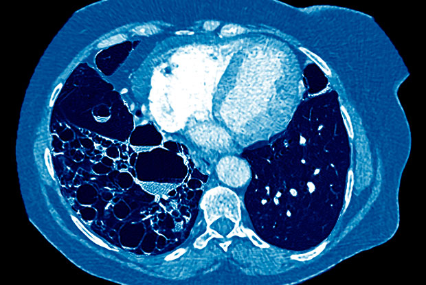 Bronchiectasis: clinical review | GPonline