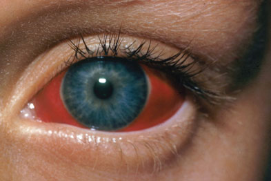 Pictorial case study - Red eye with unaffected vision | GPonline
