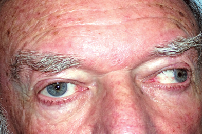 Case study - Eye pain and double vision | GPonline