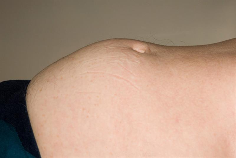 Urinary Retention Red Flag Symptoms GPonline