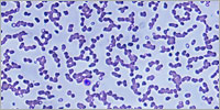 Macrocytosis | GPonline