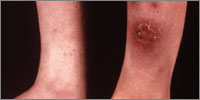 Pictorial Case Study: Pyoderma gangrenosum | GPonline