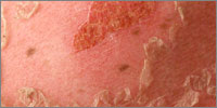Managing cases of severe sunburn | GPonline