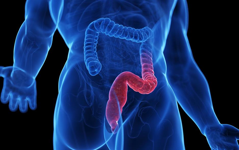 Ulcerative colitis | MIMS online