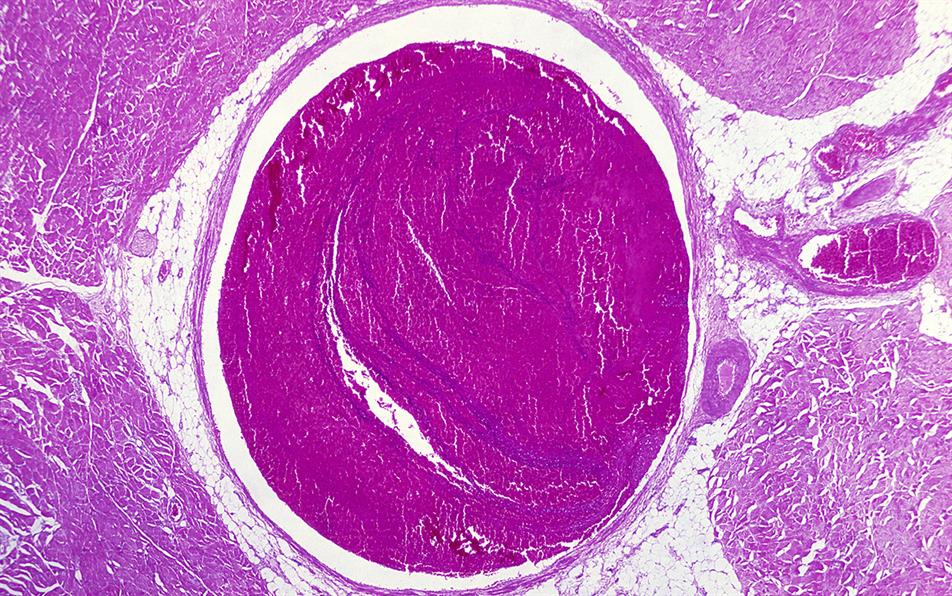NICE approves apixaban for treatment of DVT and pulmonary embolism ...