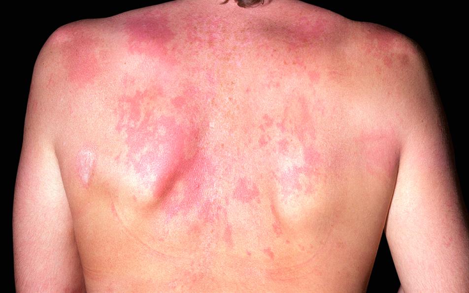 NICE approves lupus treatment | MIMS online