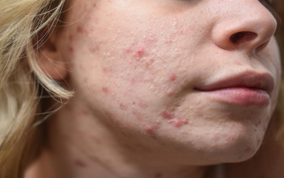 New summary of NICE acne guideline from MIMS | MIMS online