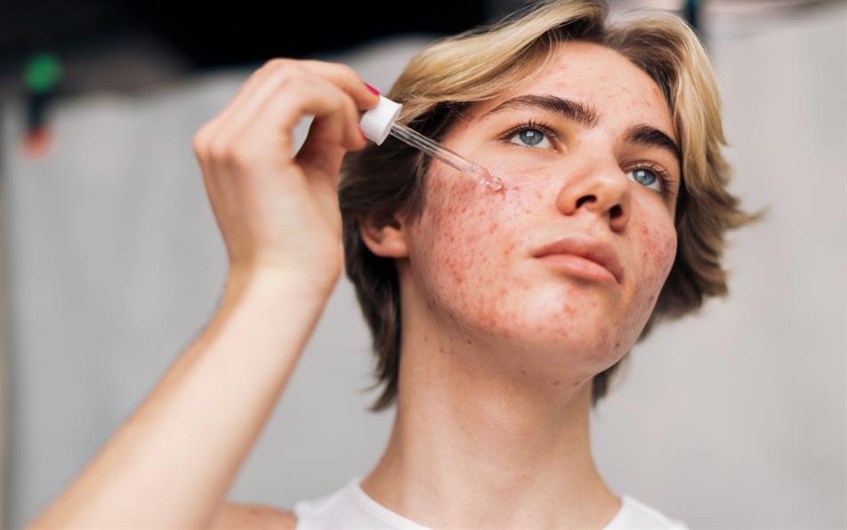 Updated acne prescribing guidance outlined in MIMS Learning module ...