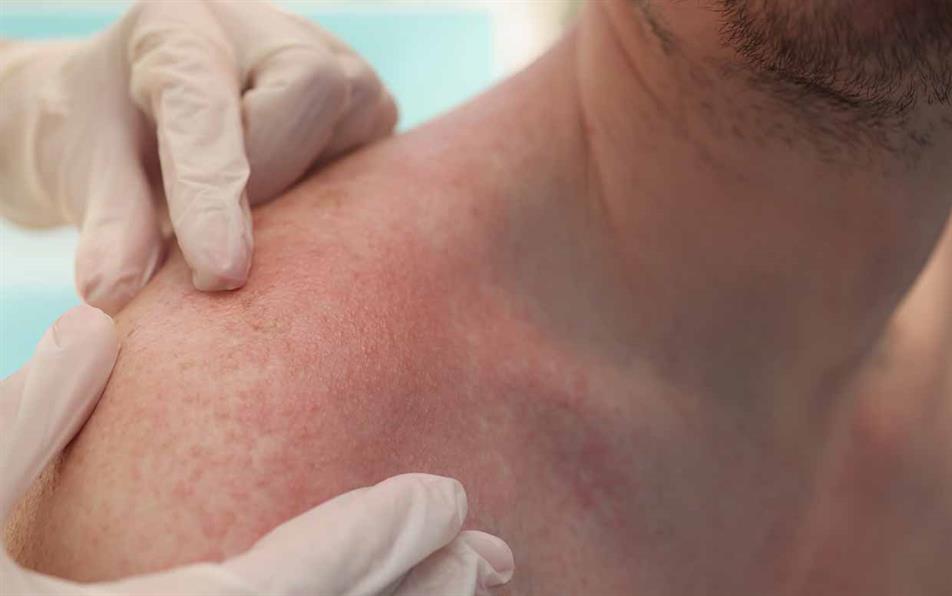 Methotrexate sun protection reminder after patient death | MIMS online