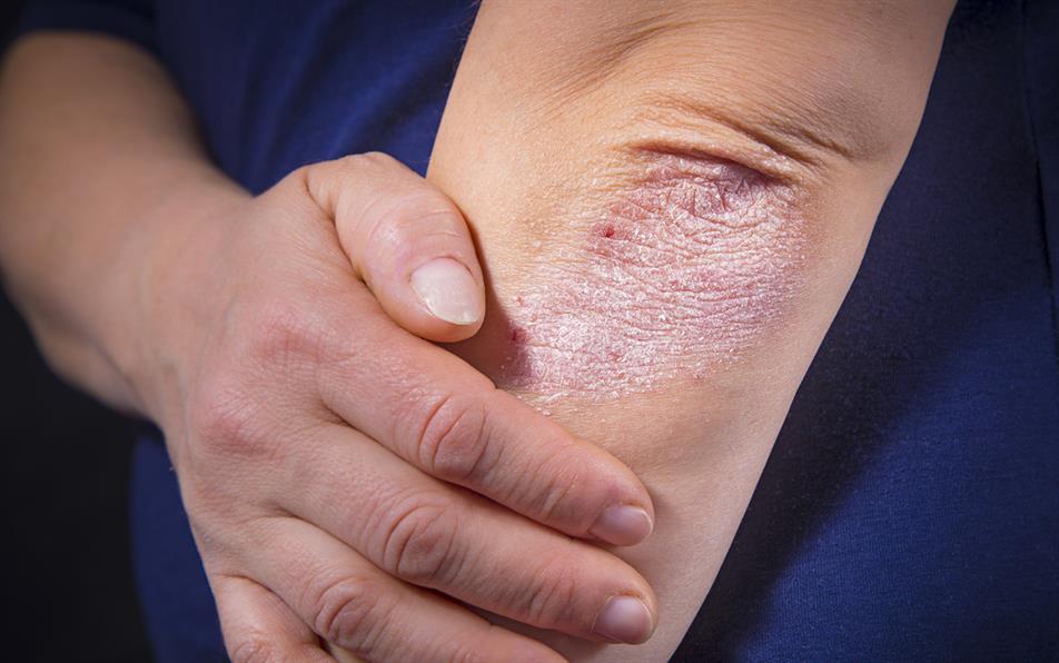 Fumaric acid ester now available as licensed oral psoriasis treatment ...