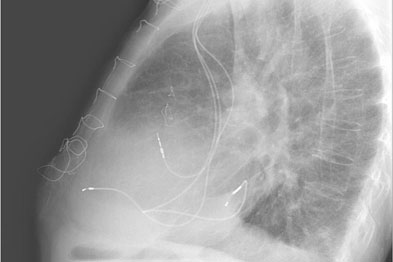 Clinical Review - Chronic heart failure | GPonline