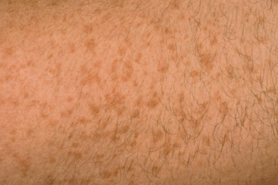 Case study - A transient purpuric rash with vomiting | GPonline