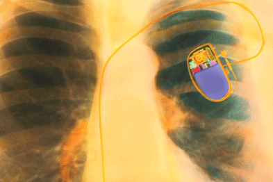 Understanding pacemaker interference | GPonline