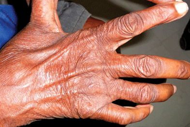 Recognise and manage leprosy | GPonline