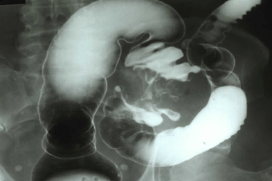 Clinical Review - Large bowel obstruction | GPonline