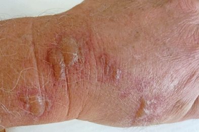Case Study - A blistered hand | GPonline
